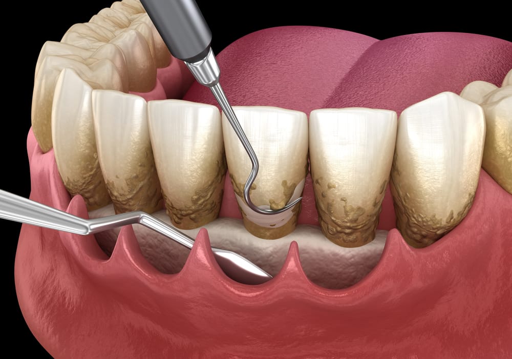 Gingival Curettage: Procedure, Benefits, and Recovery