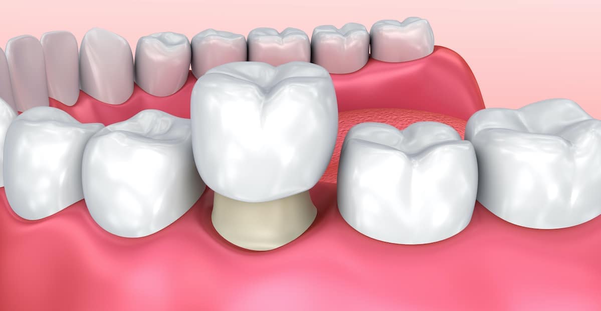 Strip Crowns: Beautiful Smiles for Kids with Natural-Looking Crowns ...