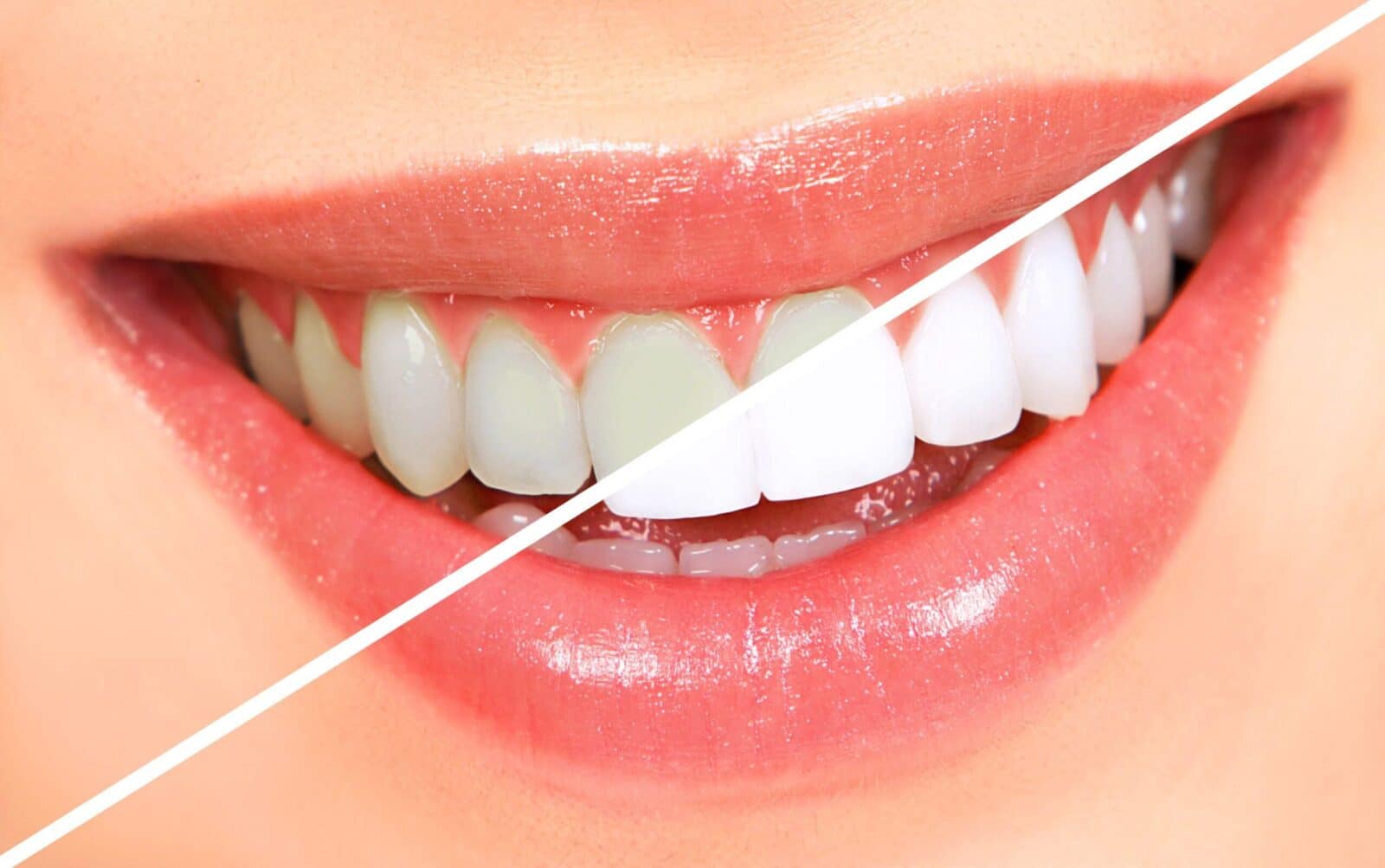 Zoom Bleaching: Achieve Whiter Teeth in Just One Session - Dr Balaji ...