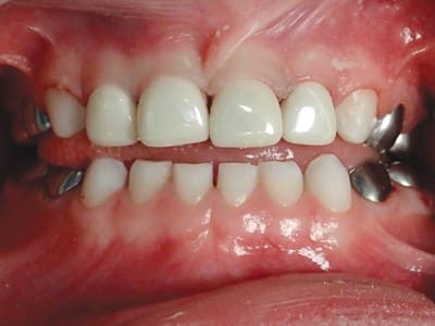 Strip Crowns: Beautiful Smiles for Kids with Natural-Looking Crowns ...