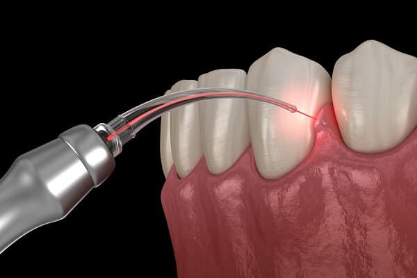 Laser Frenectomy: Experience-precision and Comfort with Advanced Laser ...